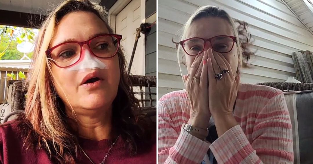 Rakovina ju pripravila o nos. Aj keď sa zo začiatku hanbila, teraz ...